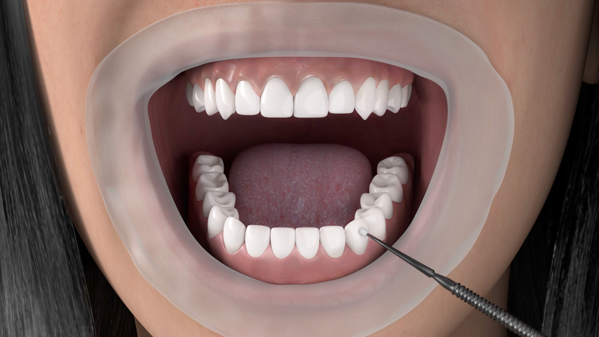 TheDentalGenius - Indirect Restorative